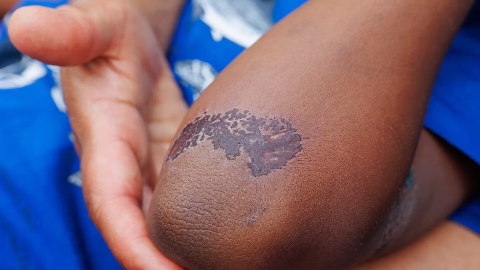 7 Most Common Camping Injuries and How to Avoid Them - The Purple Passport